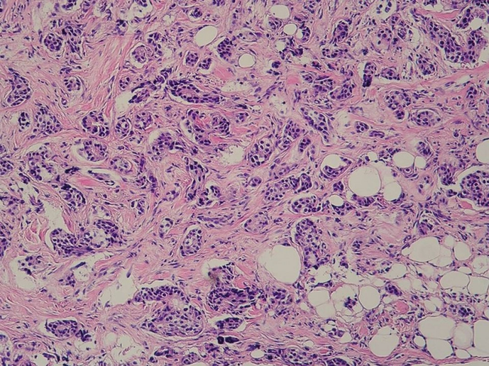 Erwachsene Frau tastet einen Tumor in der rechten Brust | VIVOCASE