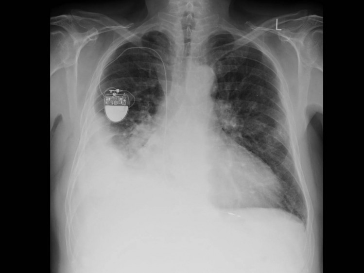 Progrediente Schwellung an der Stirn und Luftnot | VIVOCASE