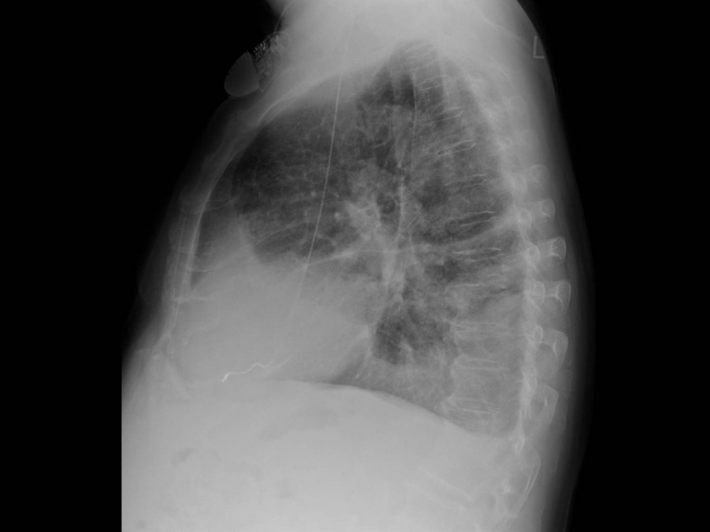 Progrediente Schwellung an der Stirn und Luftnot | VIVOCASE